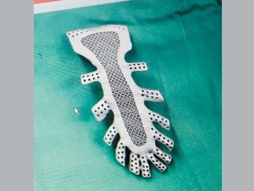 Chinese woman receives 3D-printed sternum implant - Gizbot News